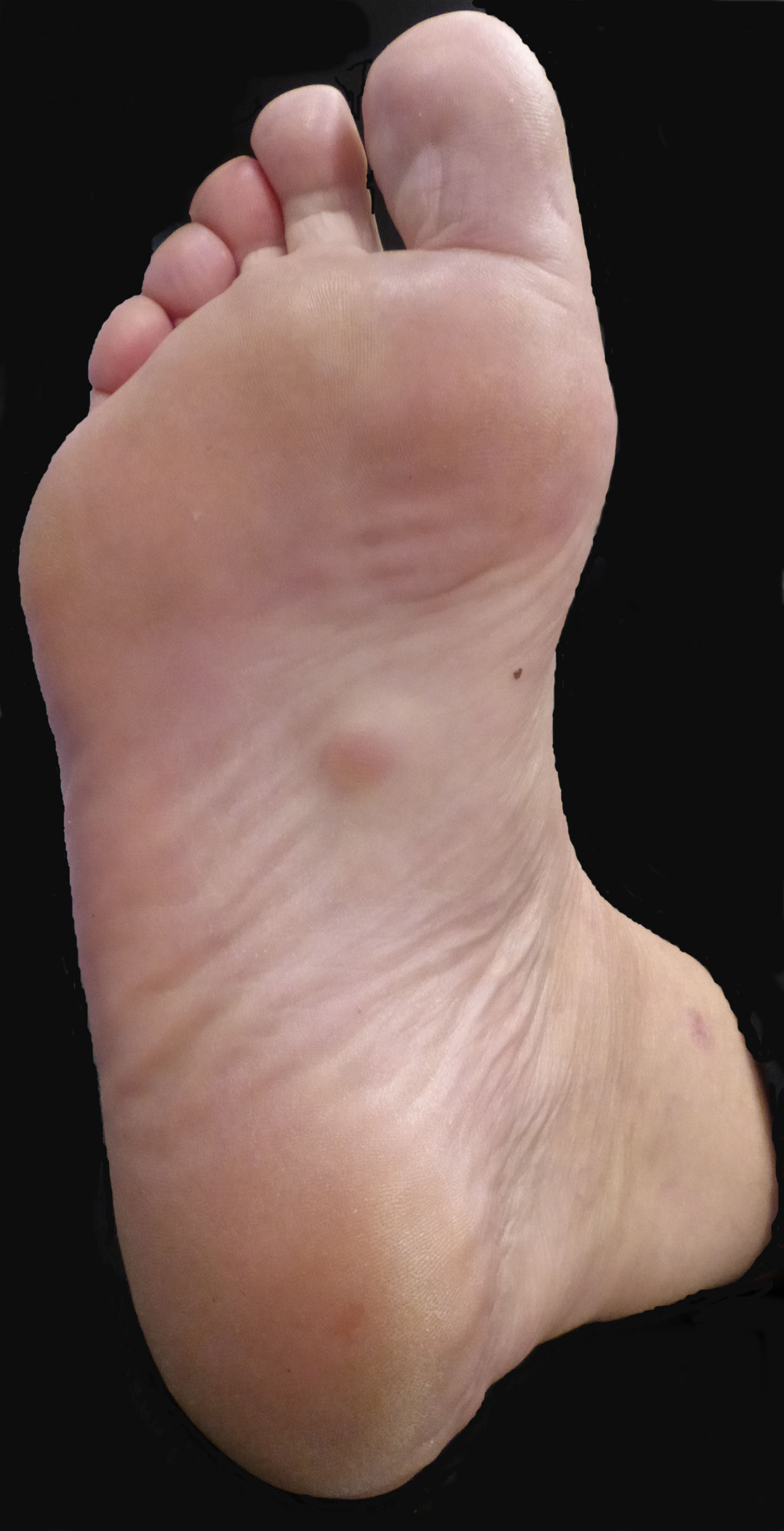 Ledderhose - Dupuytren Nederland